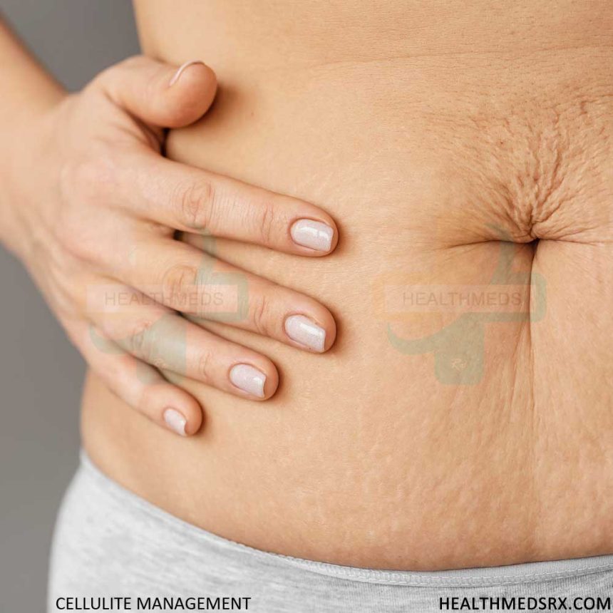 Cellulite Management- Exploring Proven Topical Treatments